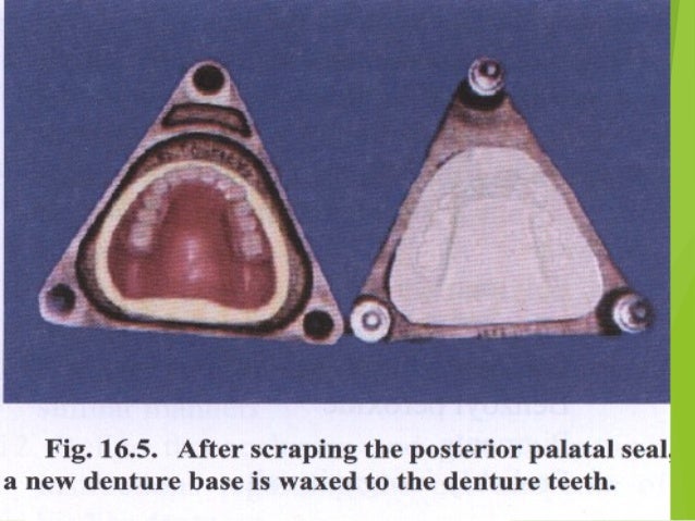 Relining And Rebasing Of Complete Dentures