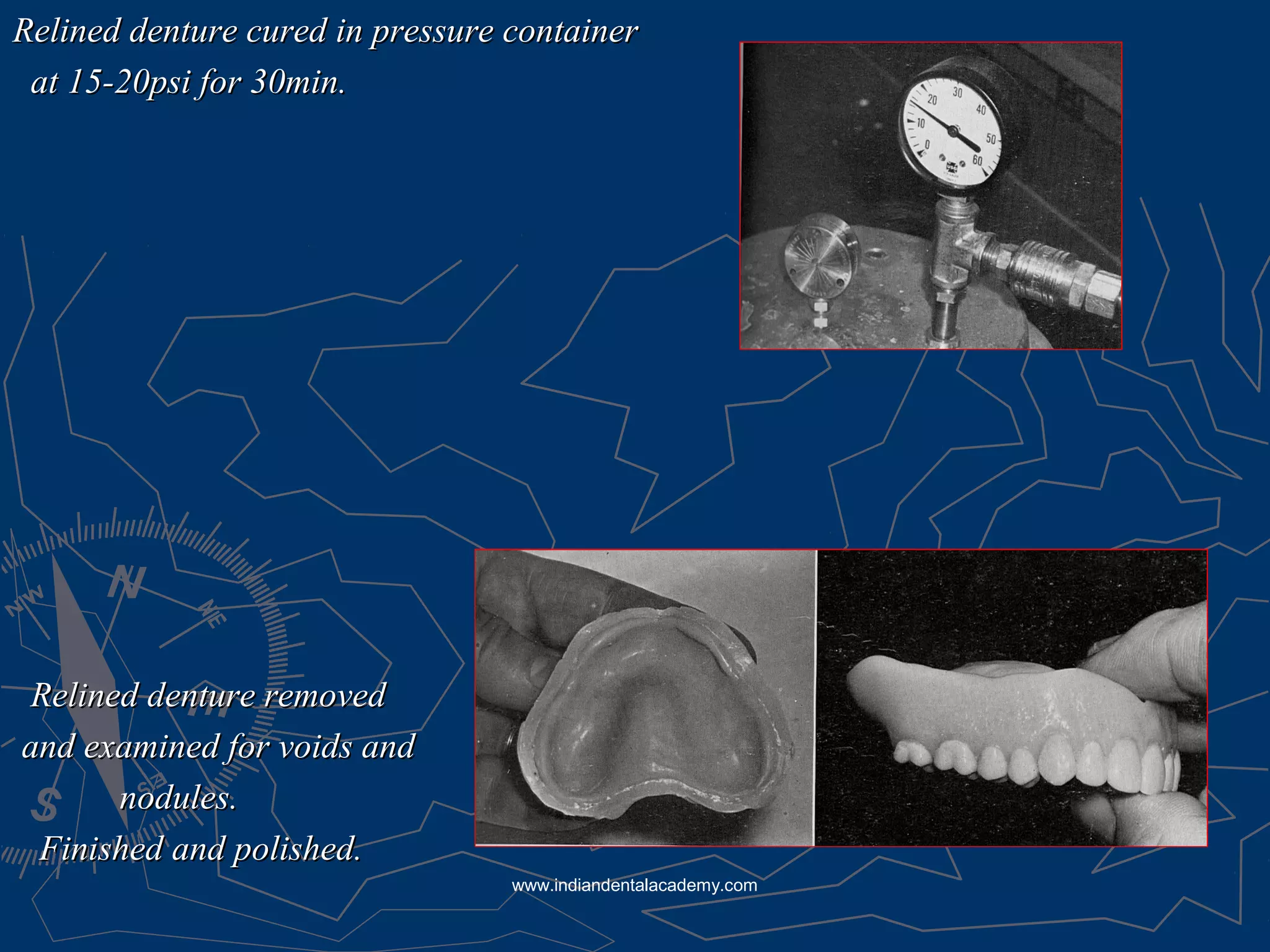 Relining rebasing and repair of complete denture/ dental courses | PPT