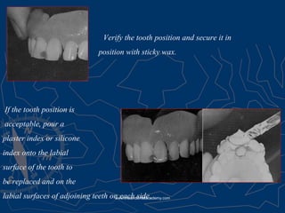 Relining rebasing and repair of complete denture/ dental courses | PPT