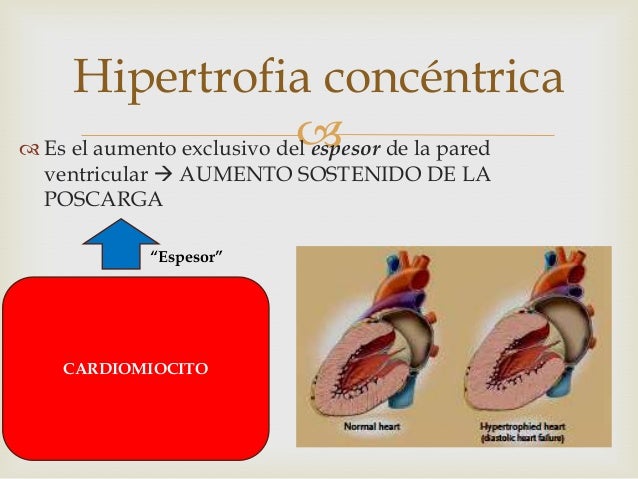 Remodelación miocárdica