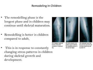 bone remodelling principles and considerations | PPTX