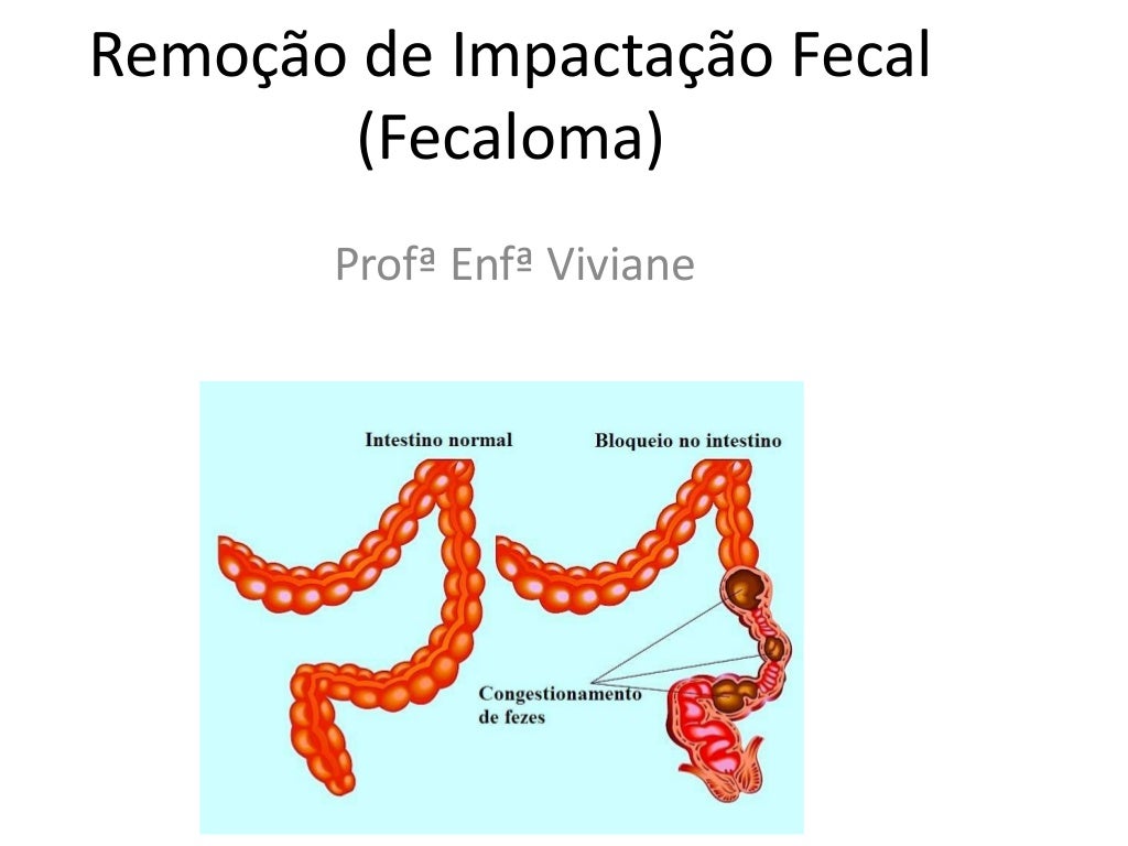 Aula Remoção manual impactação fecal (fecaloma)