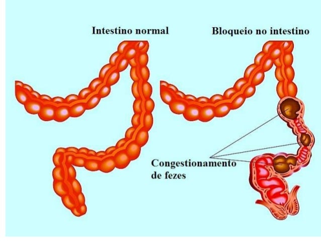 Aula Remoção manual impactação fecal (fecaloma)