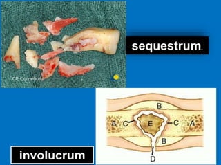 osteomyelitis | PPTX
