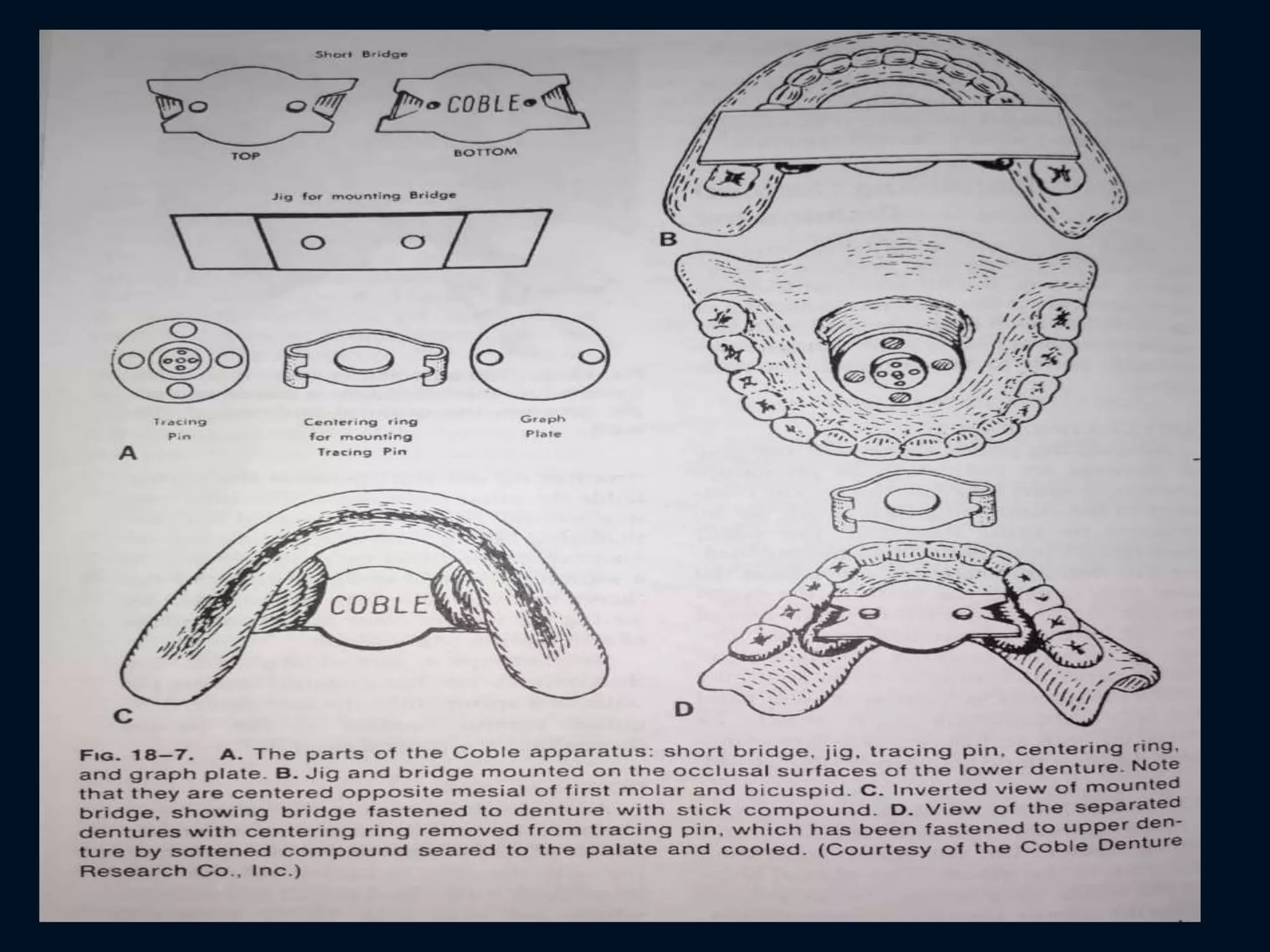 Remounting of complete dentures | PPTX