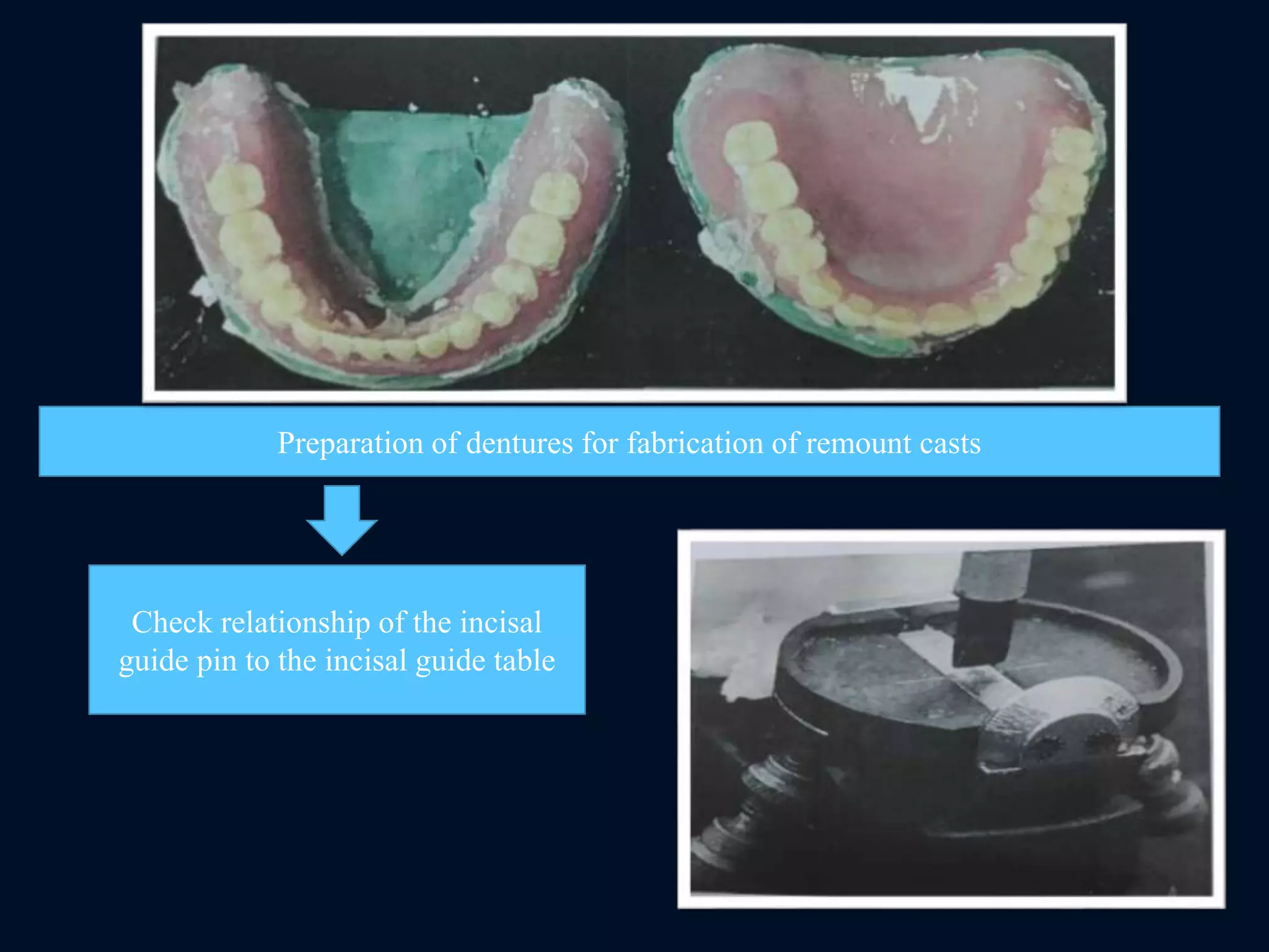 Remounting of complete dentures | PPTX