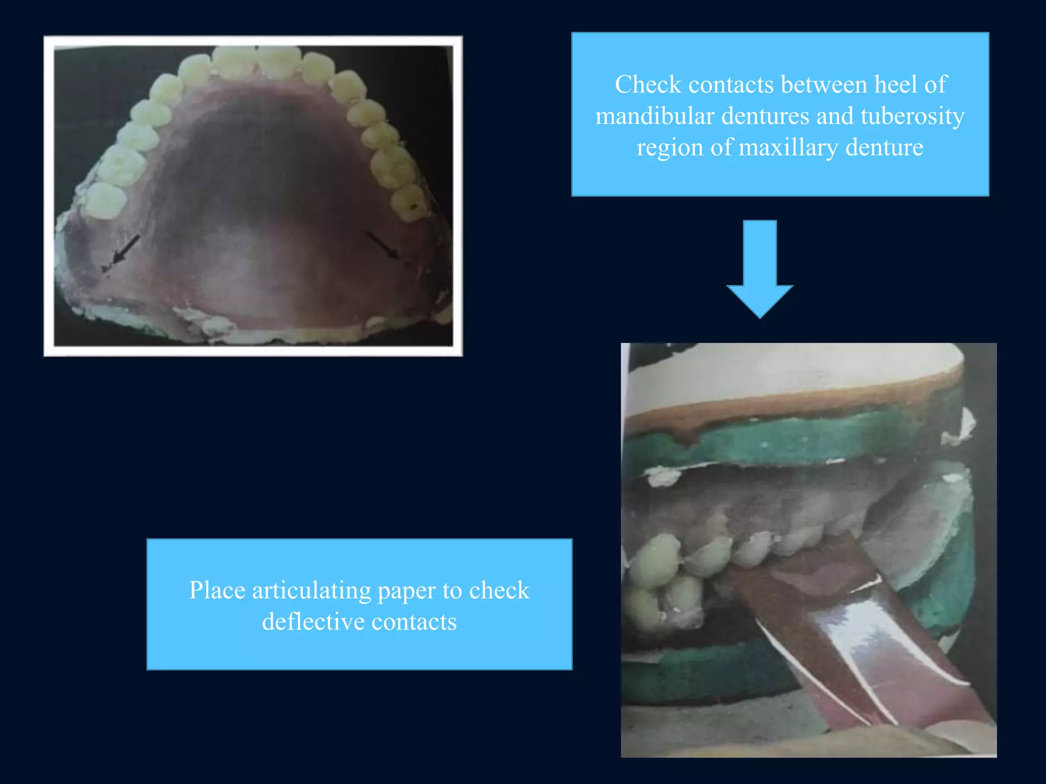 Remounting of complete dentures | PPTX