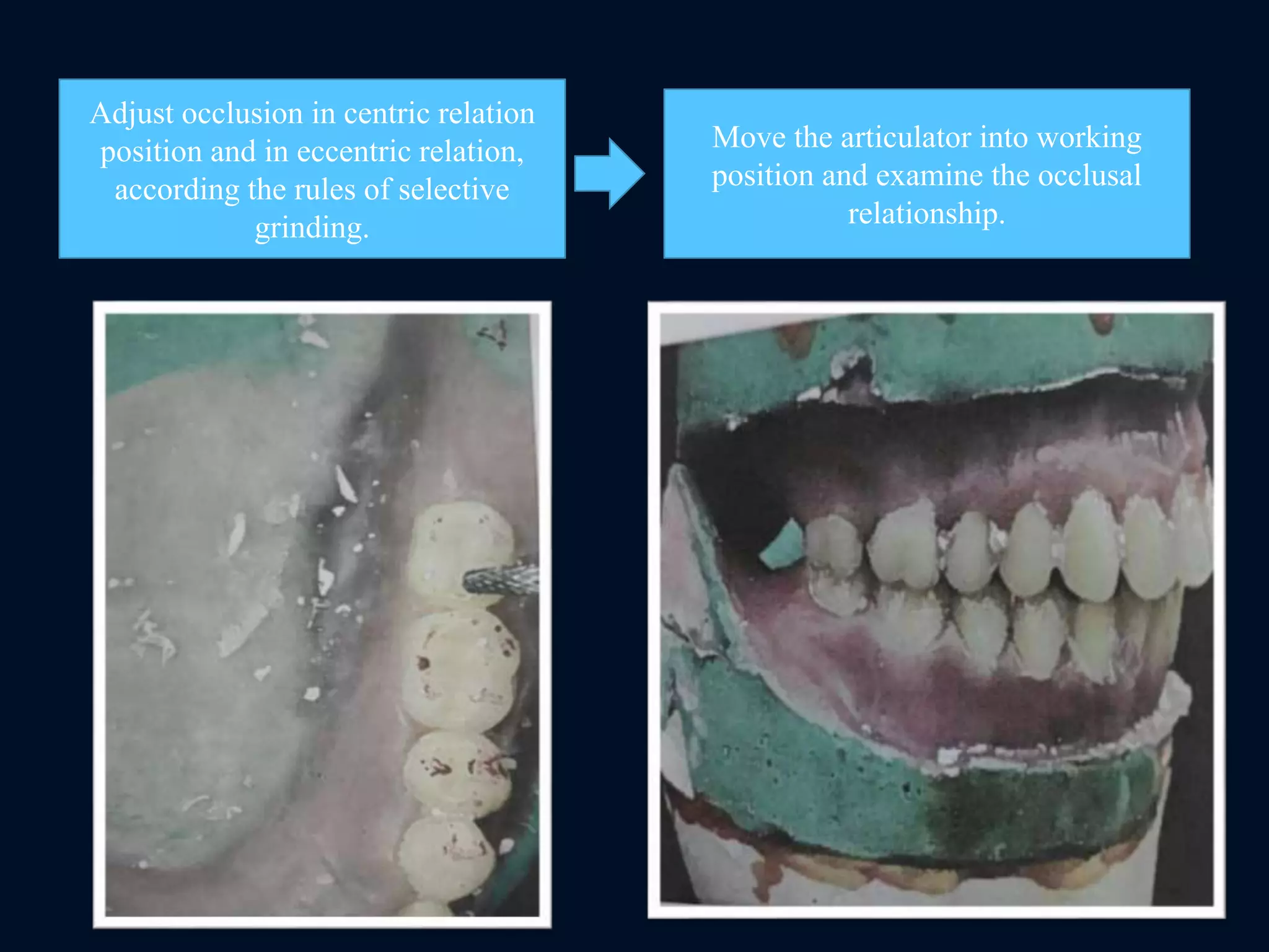 Remounting of complete dentures | PPTX
