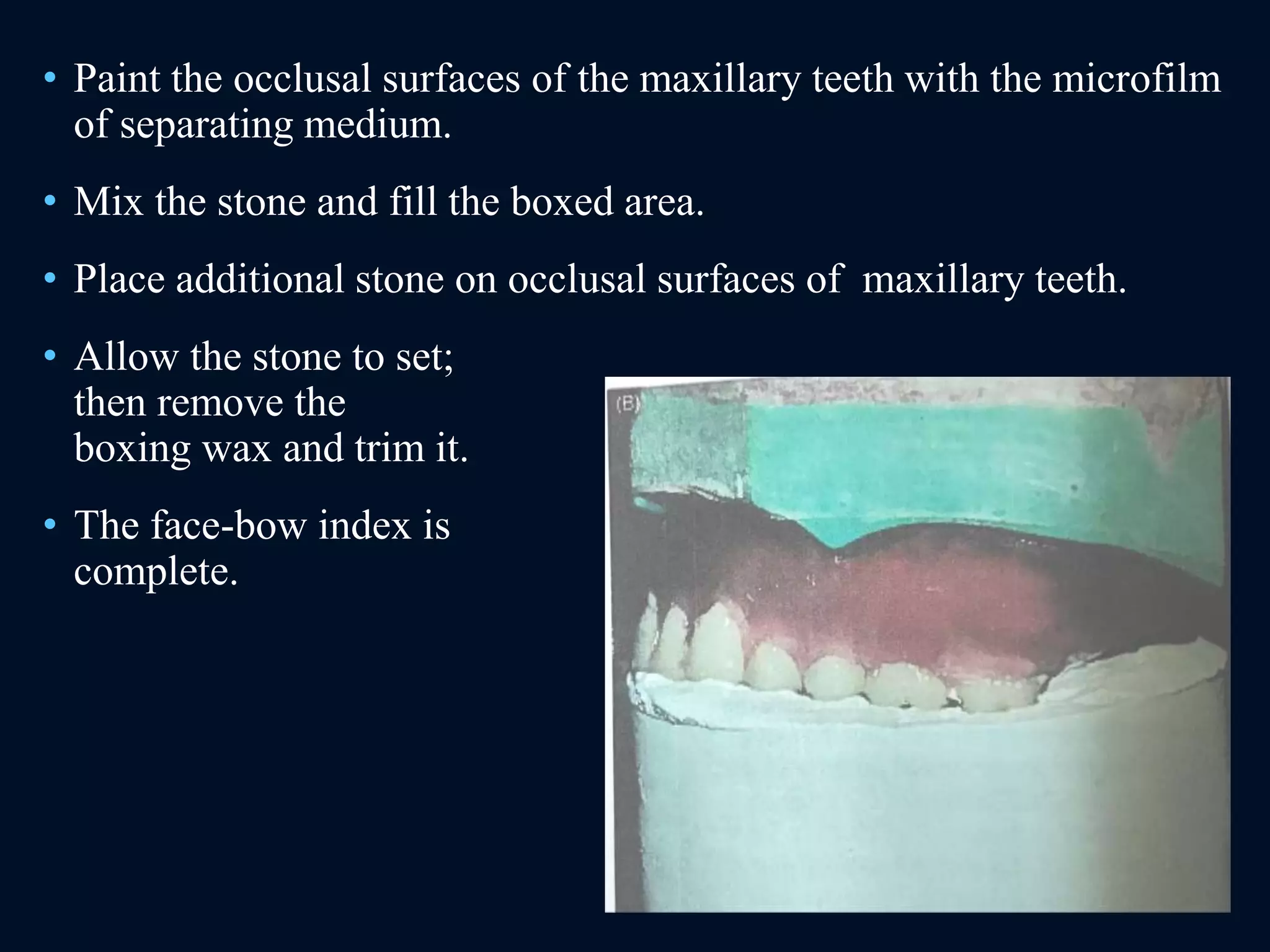 Remounting of complete dentures | PPTX