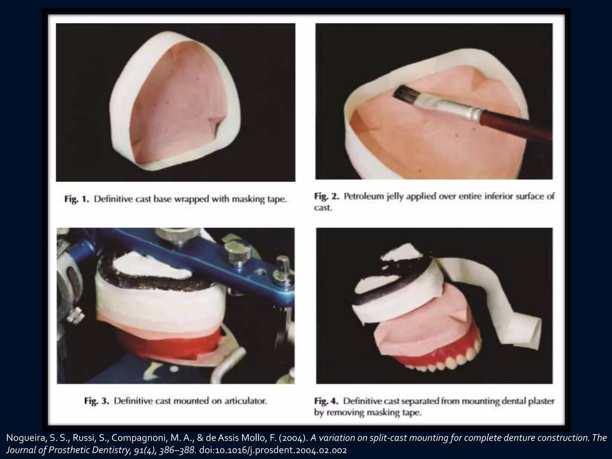 Remounting of complete dentures | PPTX