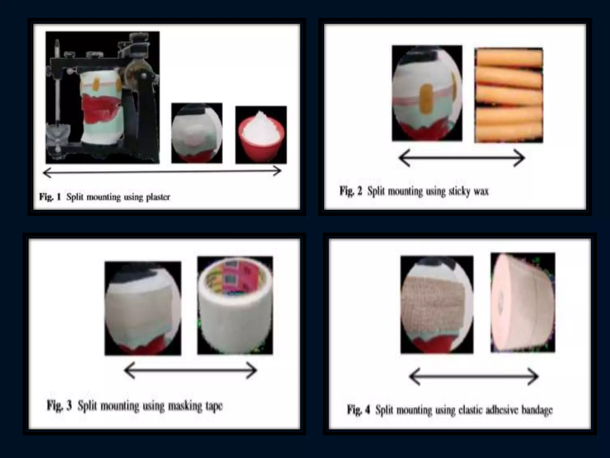 Remounting of complete dentures | PPTX