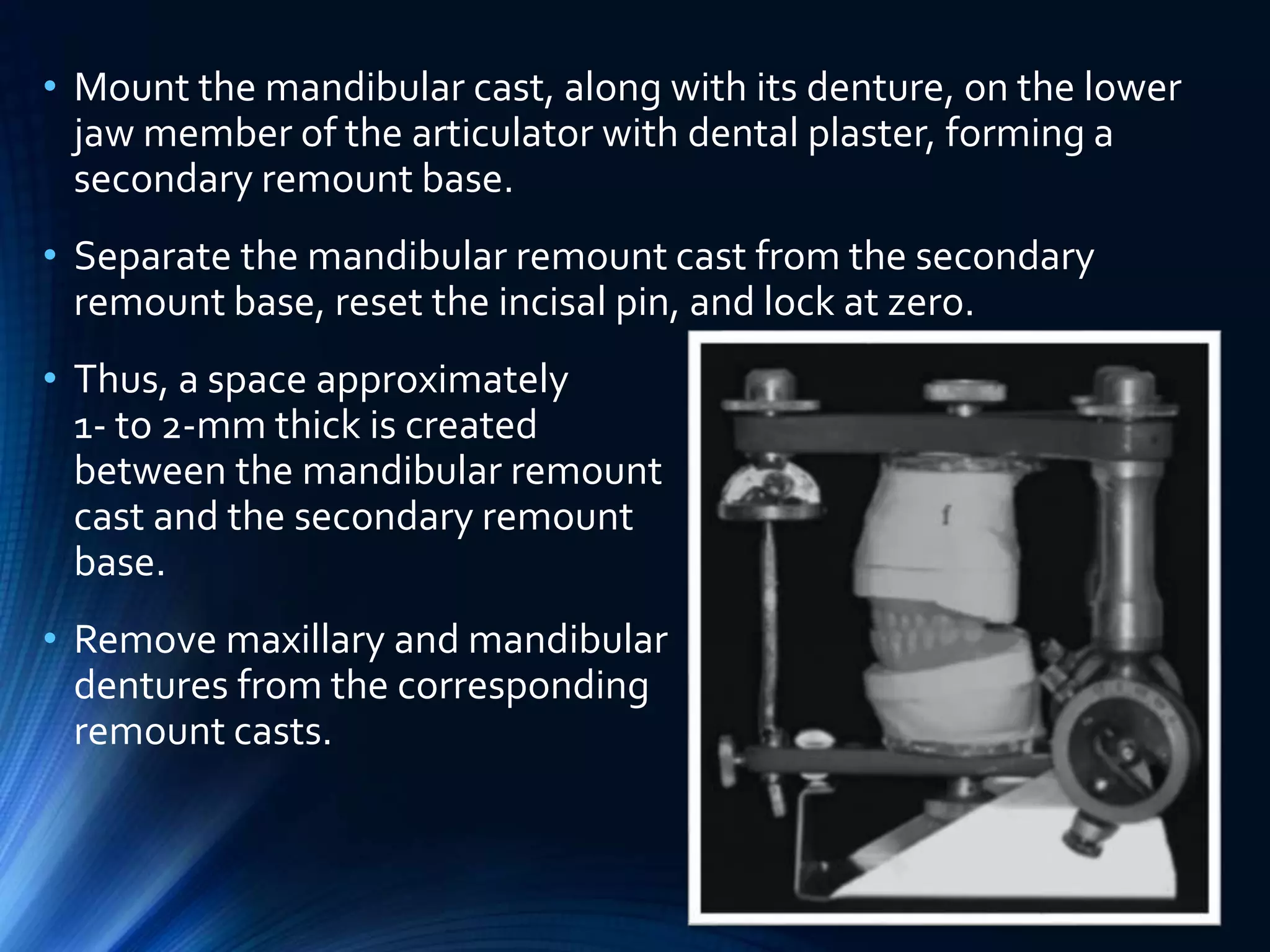 Remounting of complete dentures | PPTX
