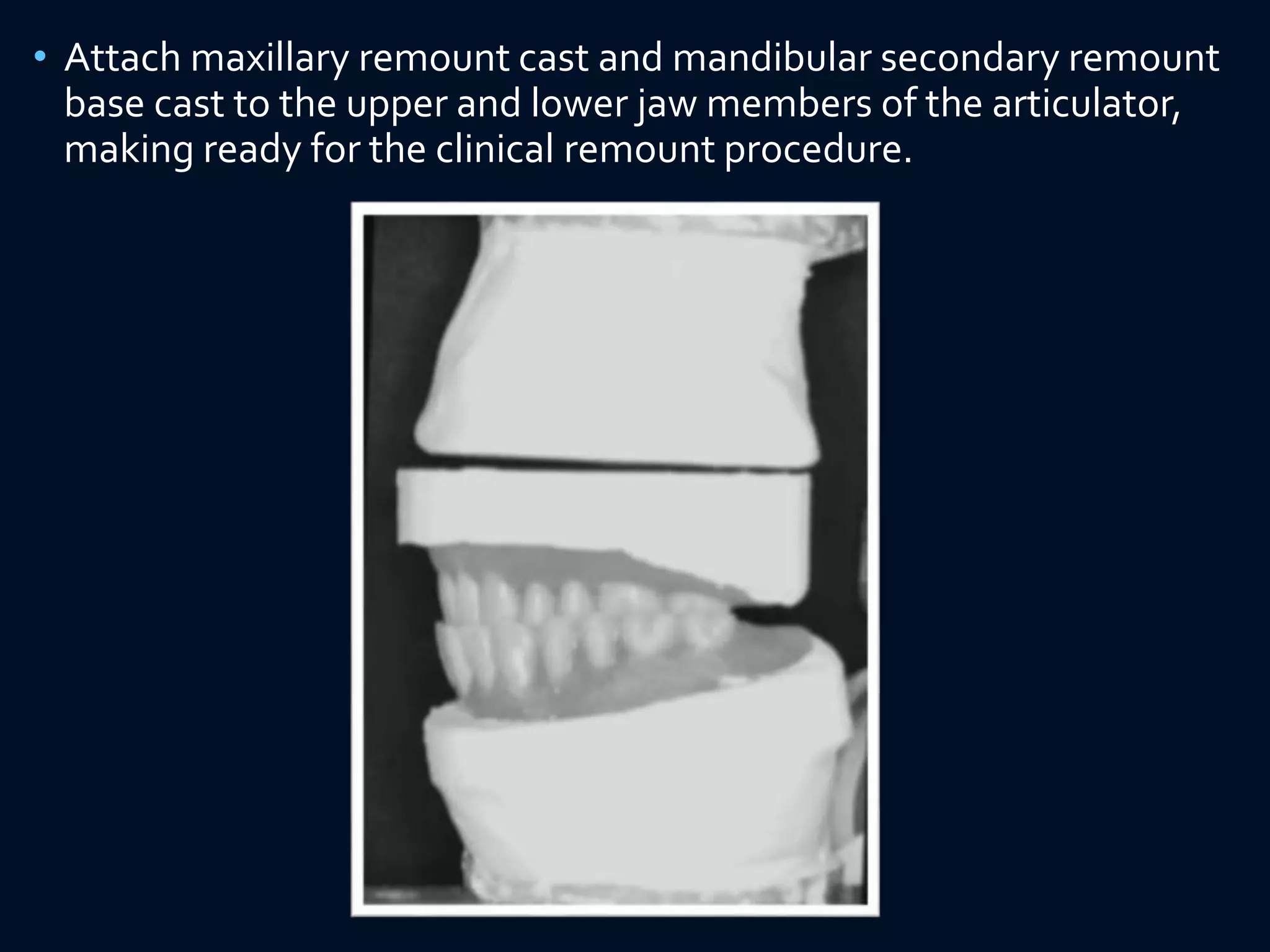 Remounting of complete dentures | PPTX