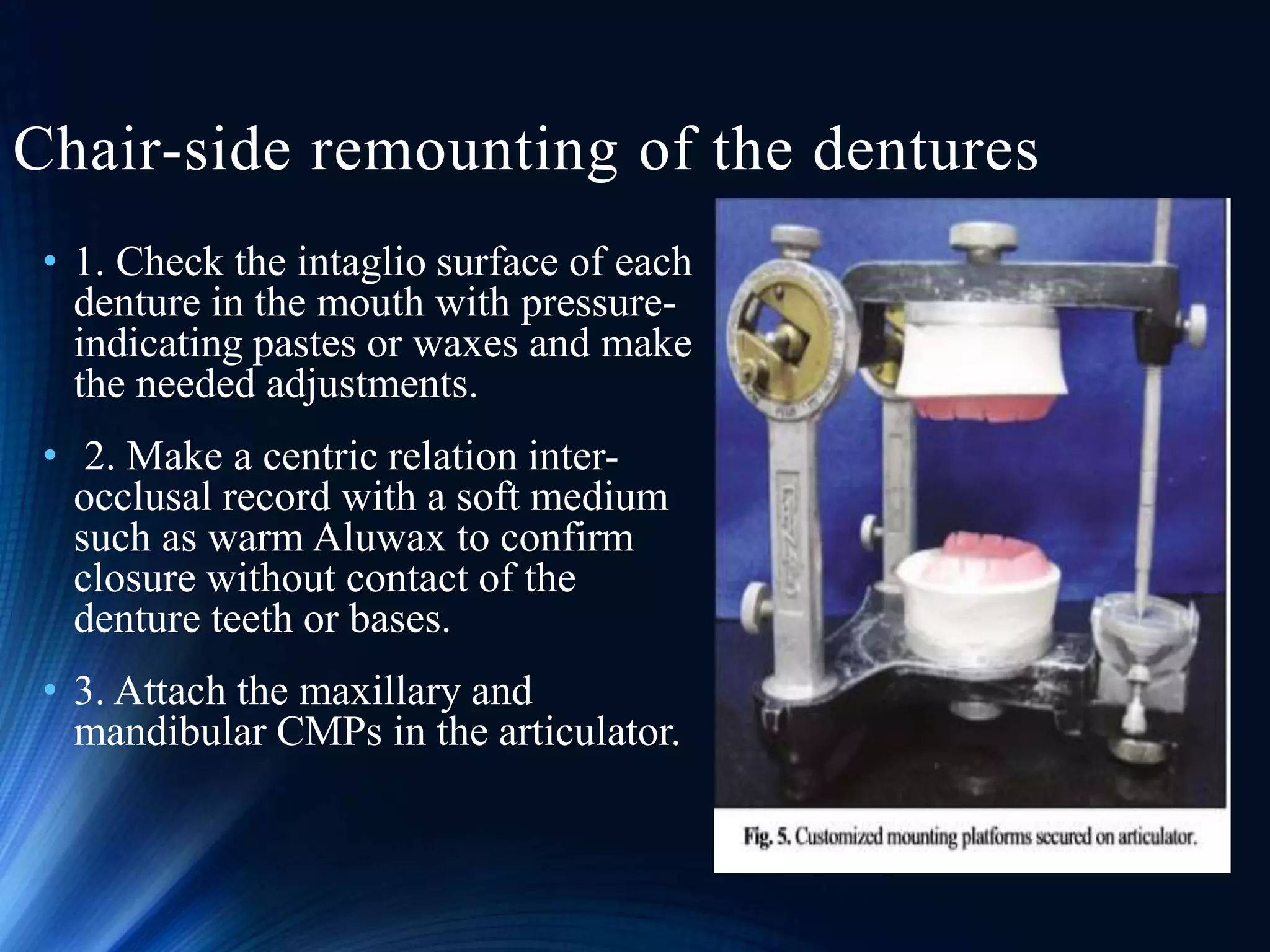 Remounting of complete dentures | PPTX