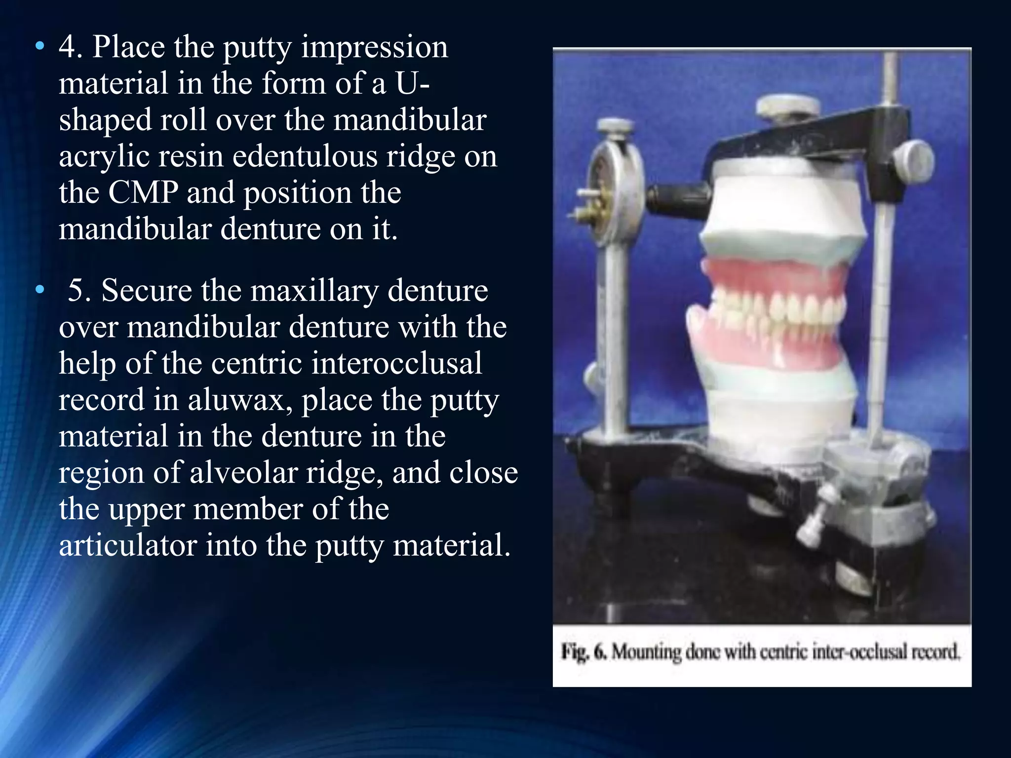 Remounting of complete dentures | PPTX