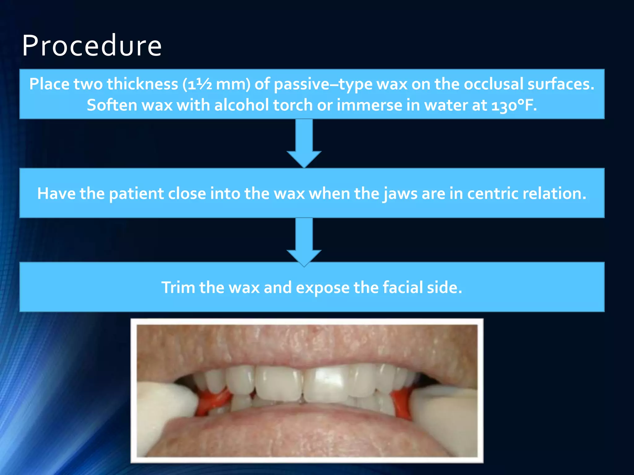 Remounting of complete dentures | PPTX