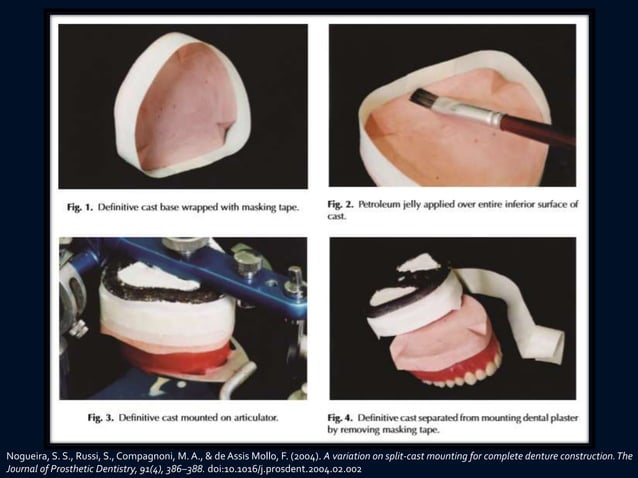 Remounting of complete dentures | PPTX | Dental Health | Diseases and ...