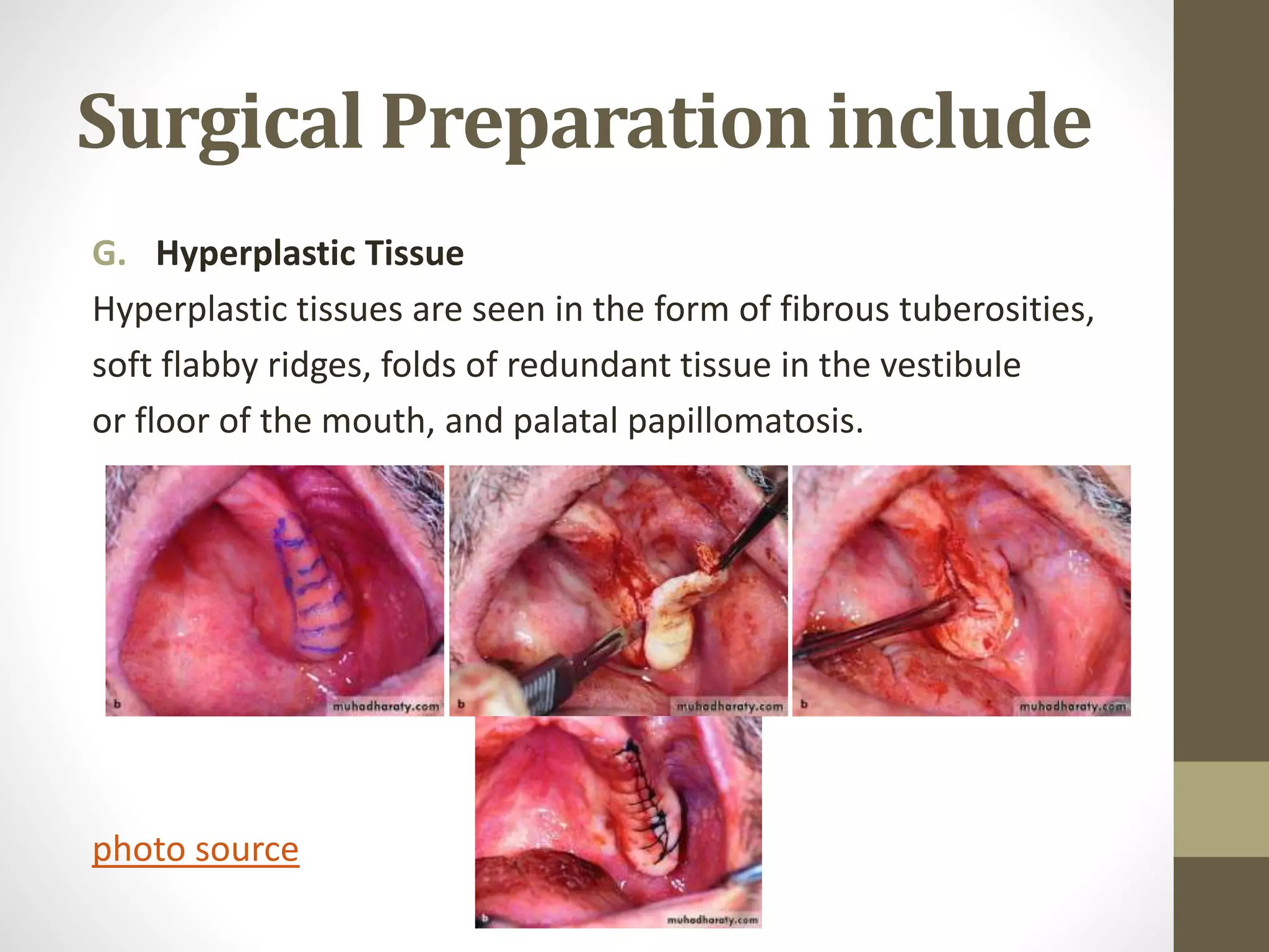 Preparation of the mouth for removable partial denture | PPTX