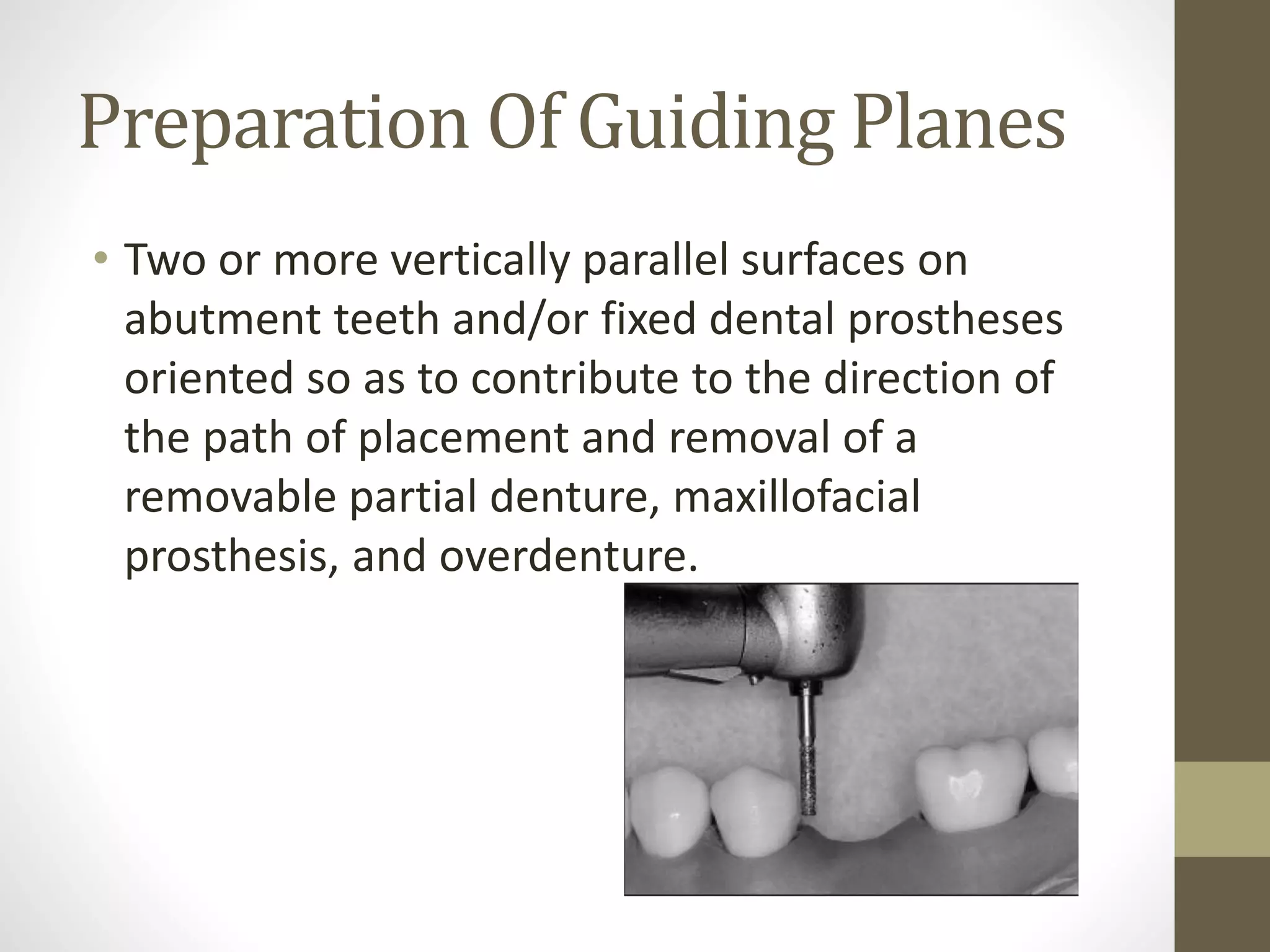 Preparation of the mouth for removable partial denture | PPTX