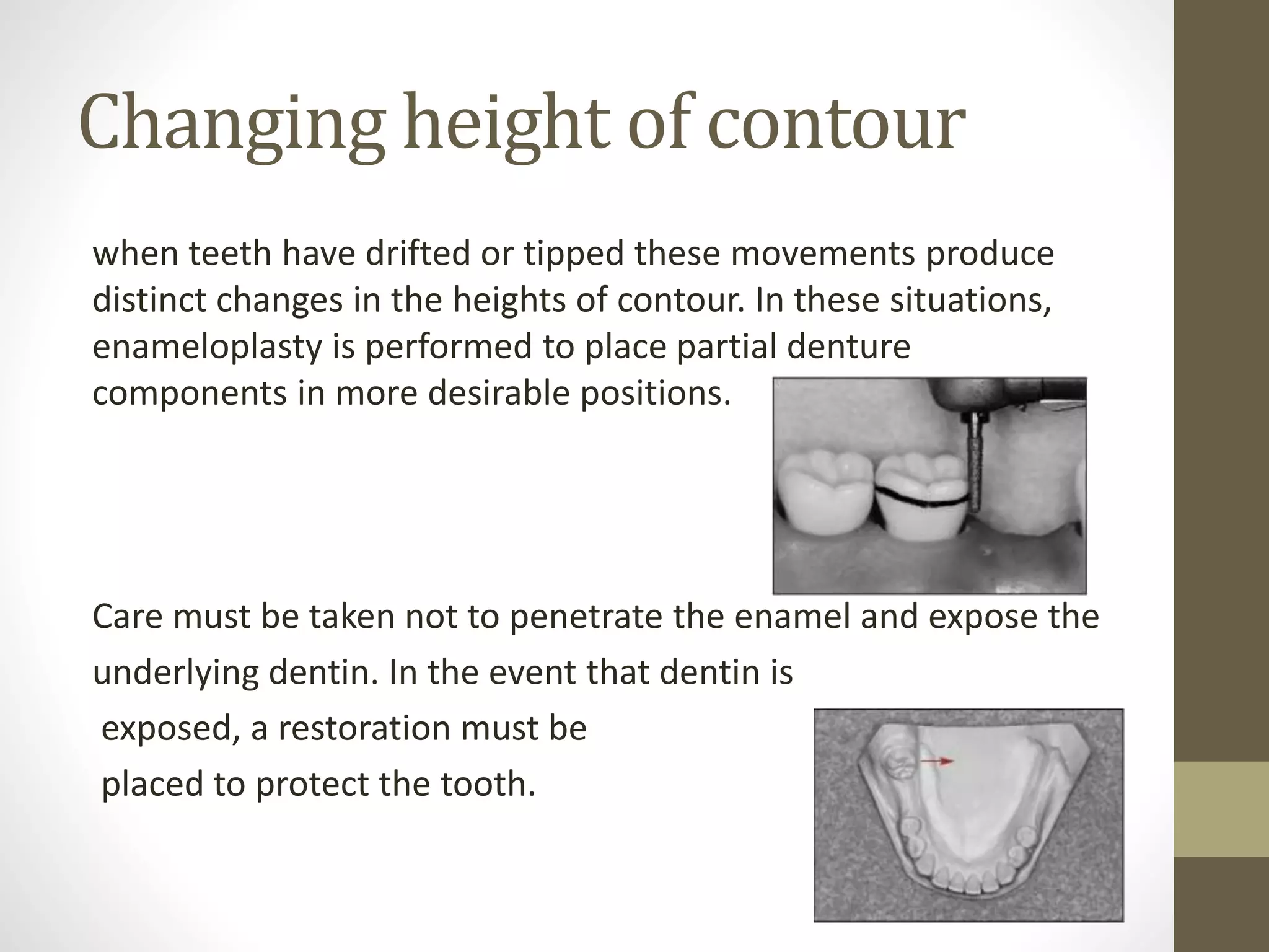Preparation of the mouth for removable partial denture | PPTX