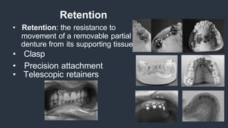 removable-partial-denture-f-f.pptx
