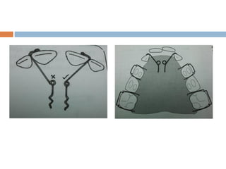 REMOVABLE APPLIANCE (2).pdf