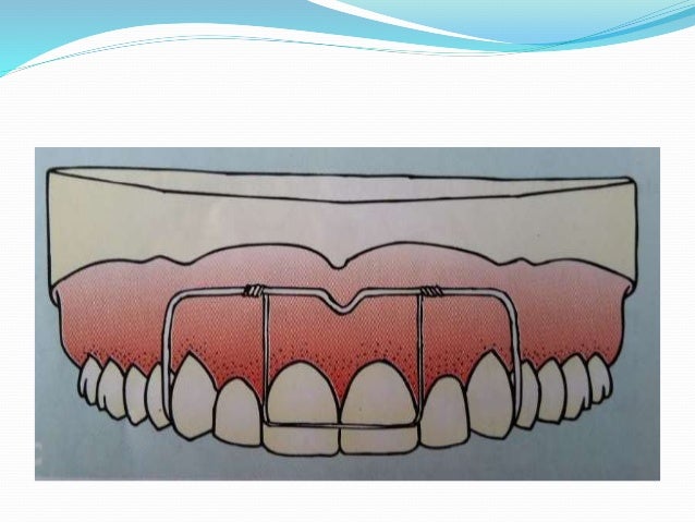 Removable appliances