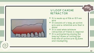Removable Appliances in Orthodontics | PPT | PDF