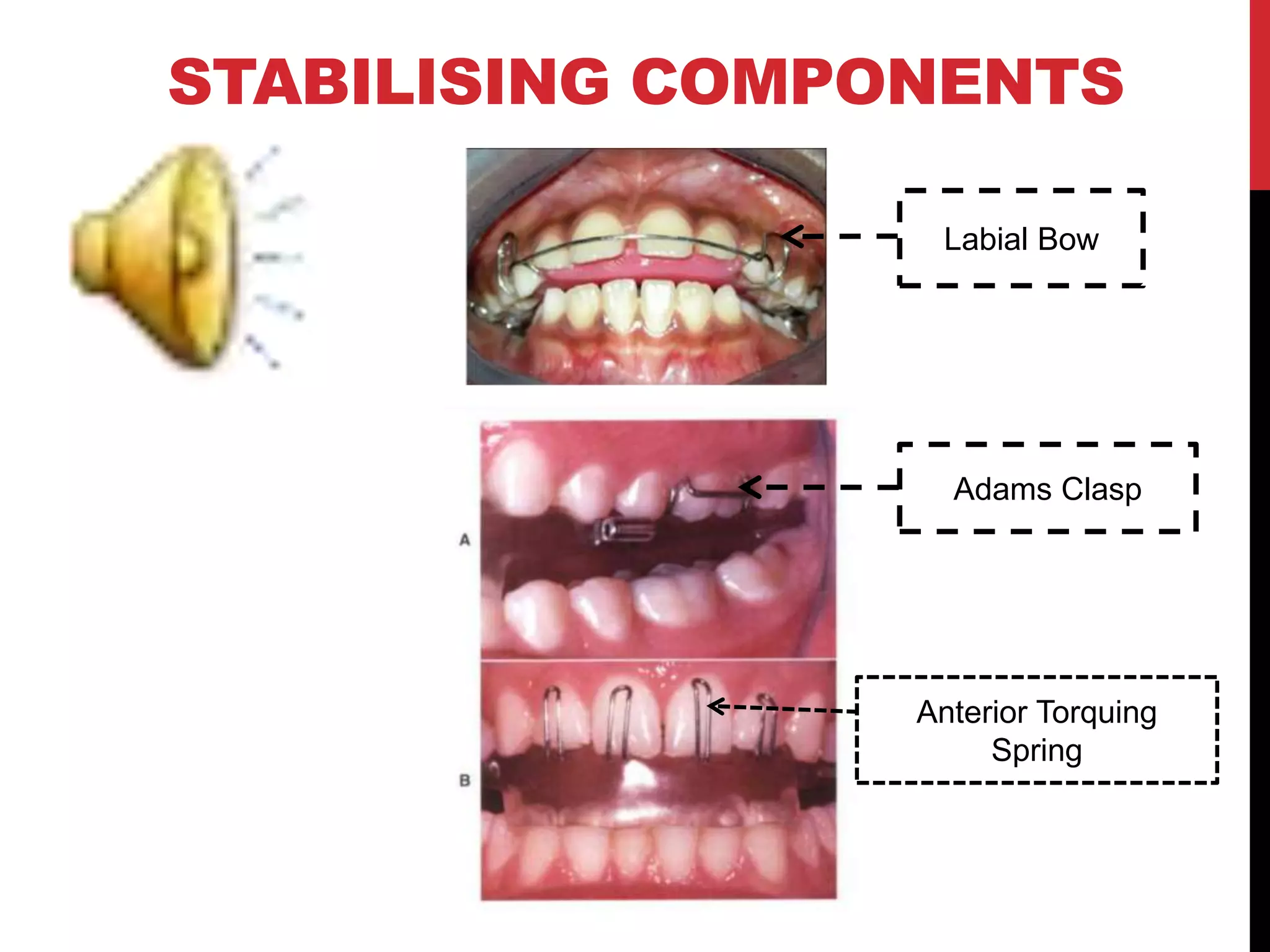 Removable appliances iii functional appliances | PPT