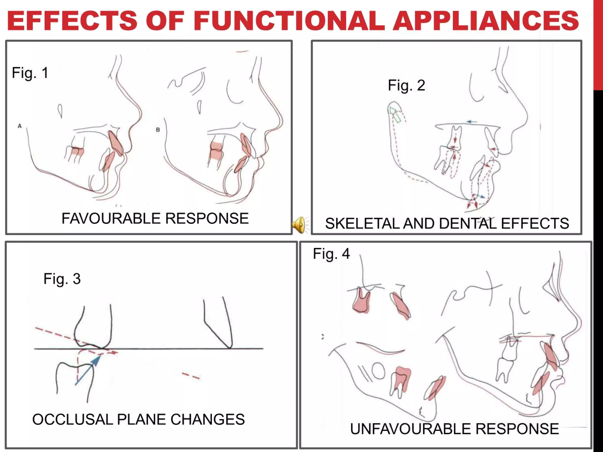 Removable appliances iii functional appliances | PPT