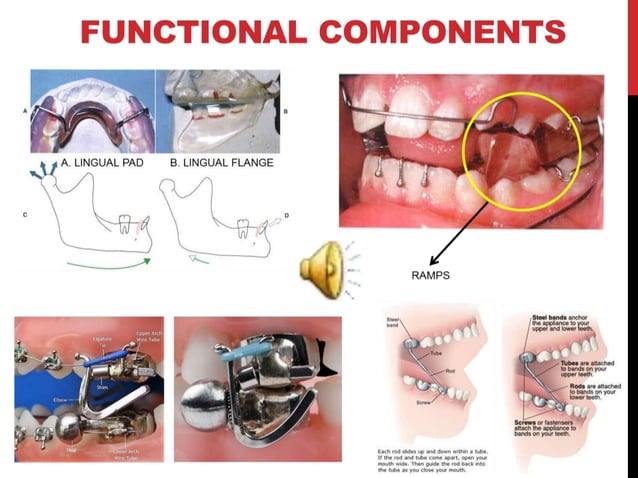 Removable appliances iii functional appliances | PPT