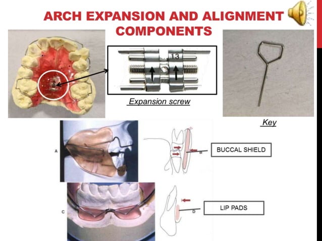 Removable appliances iii functional appliances | PPT