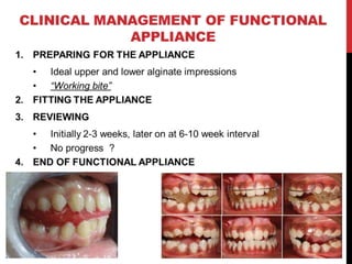 Removable appliances iii functional appliances ii | PPT