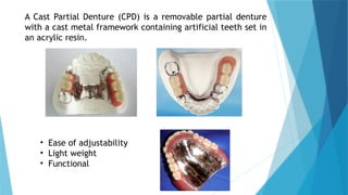 REMOVABLE Denture .pptx