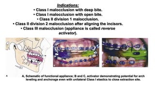 Removable functional appliance 2 | PPTX
