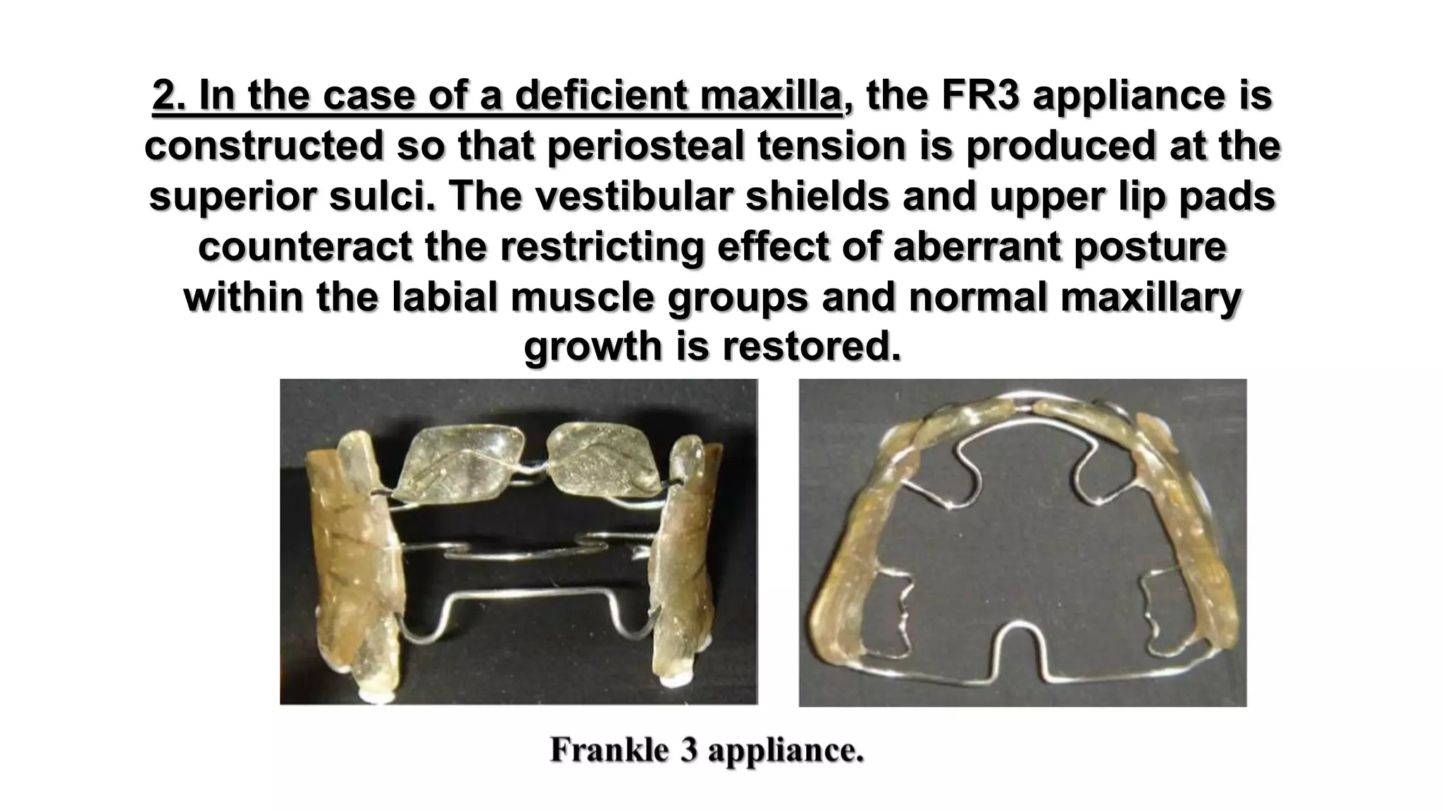 Removable functional appliance 3 | PPTX
