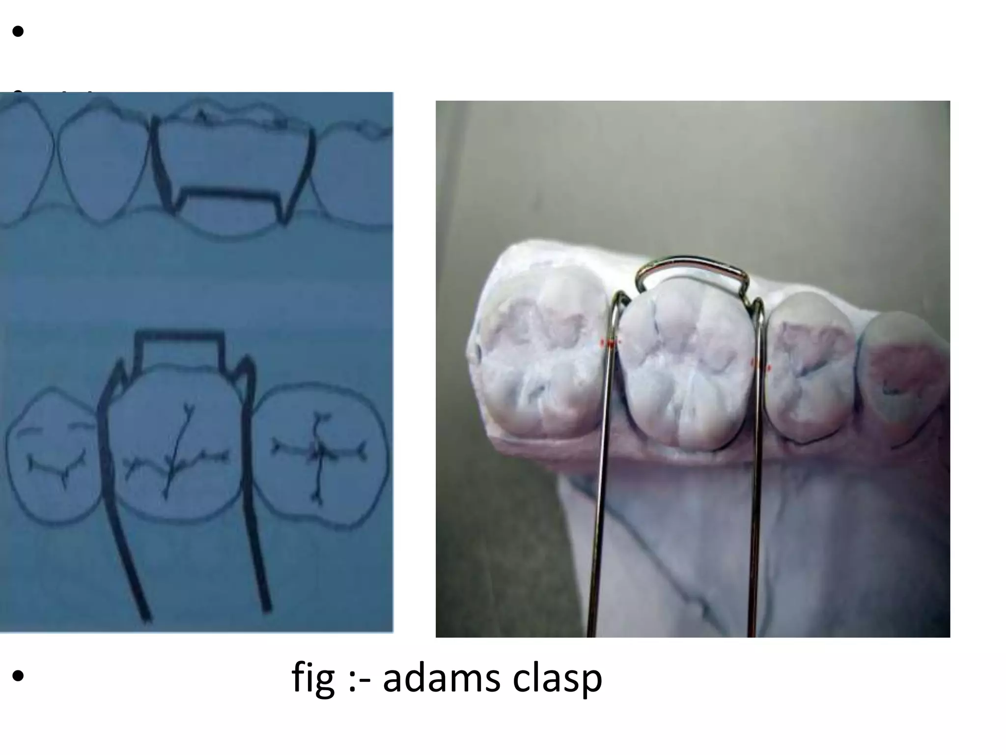 Removable orthodontic appliance | PPTX