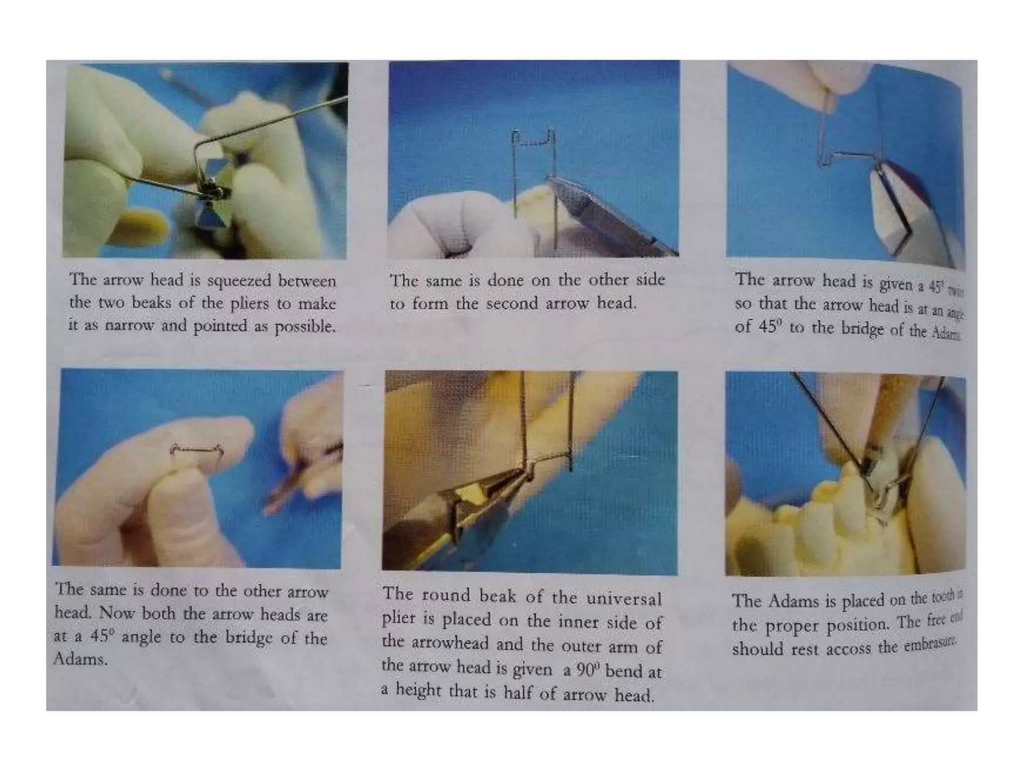 Removable orthodontic appliance | PPTX