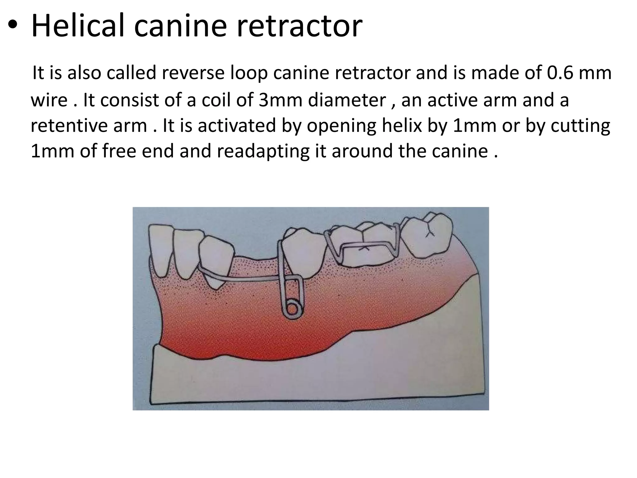 Removable orthodontic appliance | PPTX