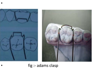 Removable orthodontic appliance | PPTX