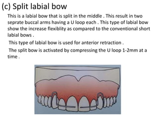 Removable orthodontic appliance | PPTX