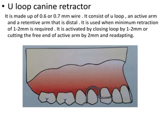 Removable orthodontic appliance | PPTX