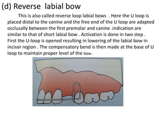 Removable orthodontic appliance | PPT