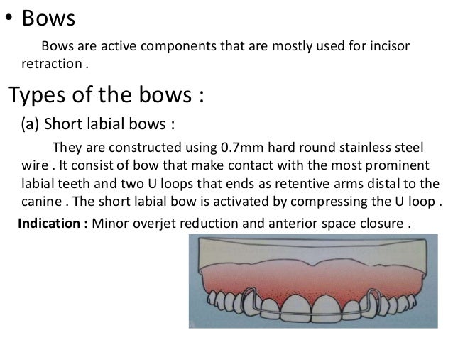 Removable orthodontic appliance