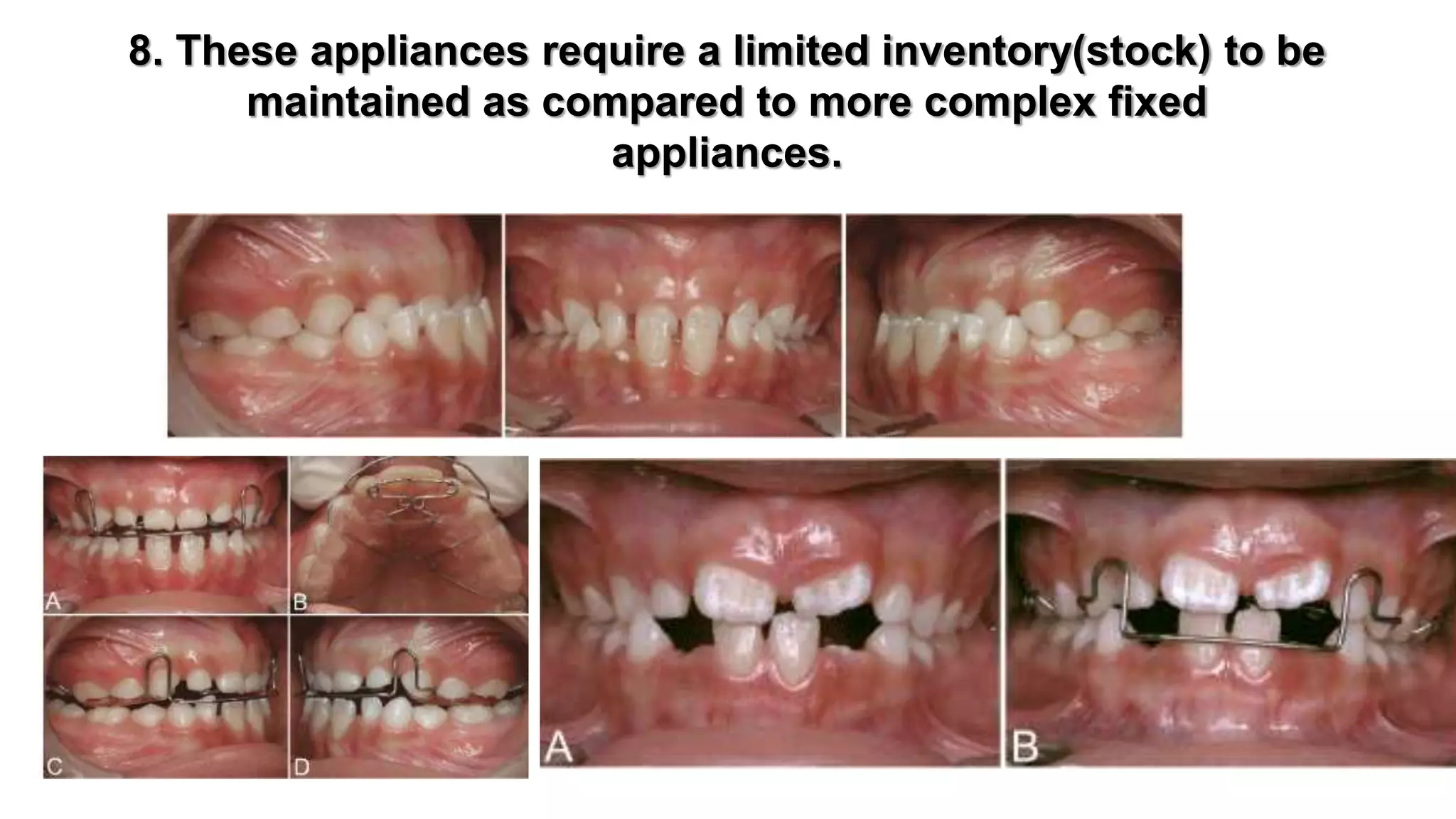 Removable orthodontic appliance | PPTX