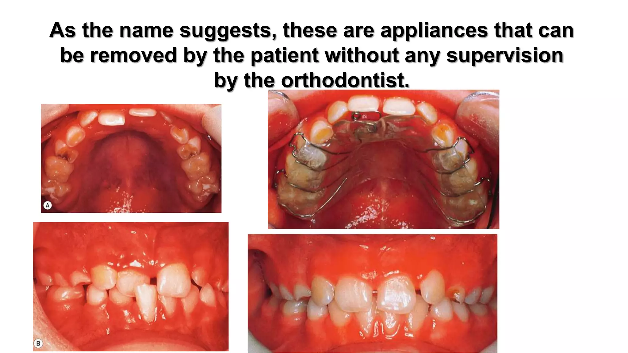 Removable orthodontic appliance | PPTX | Dental Health | Diseases and ...