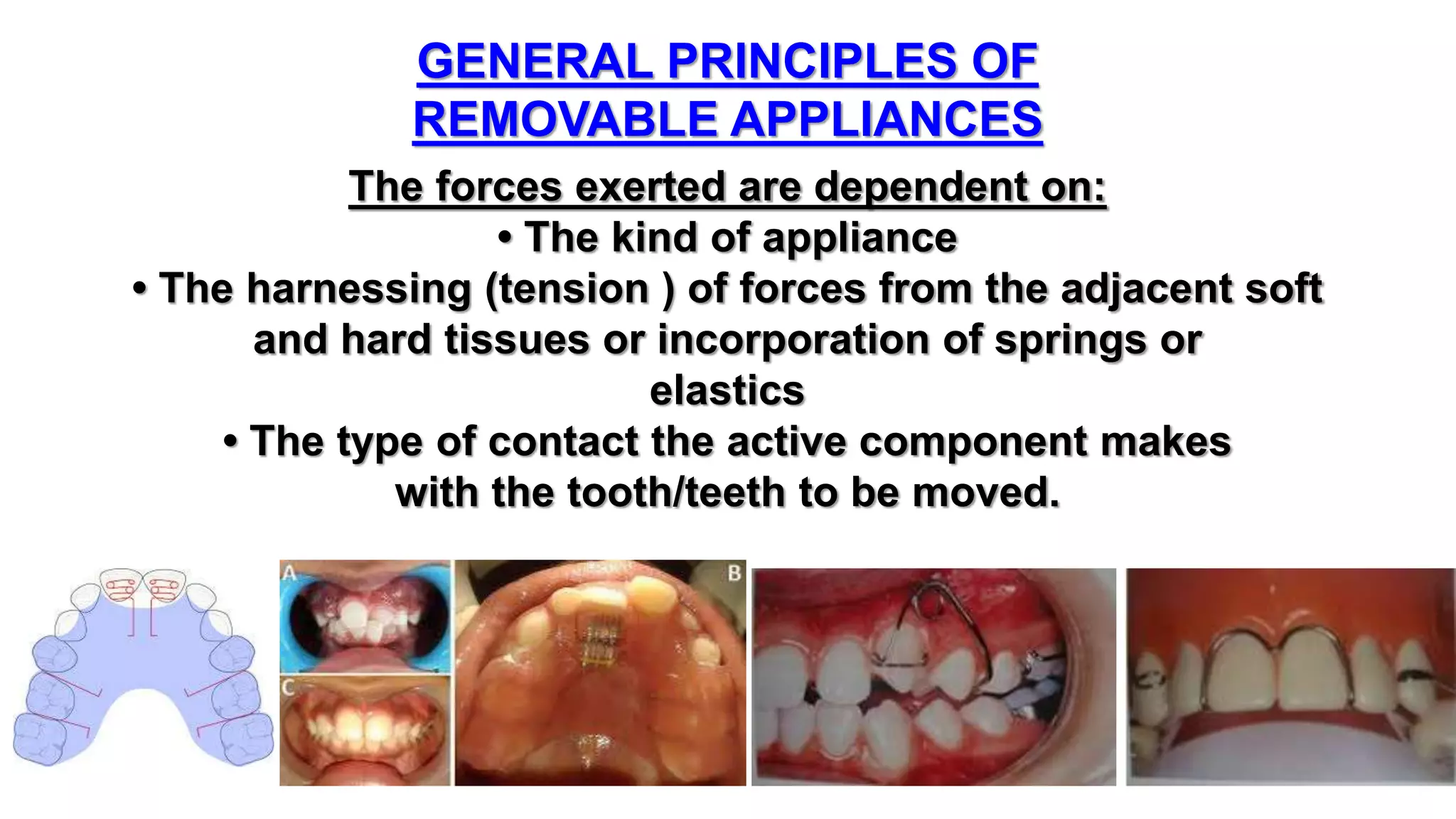 Removable orthodontic appliance | PPTX