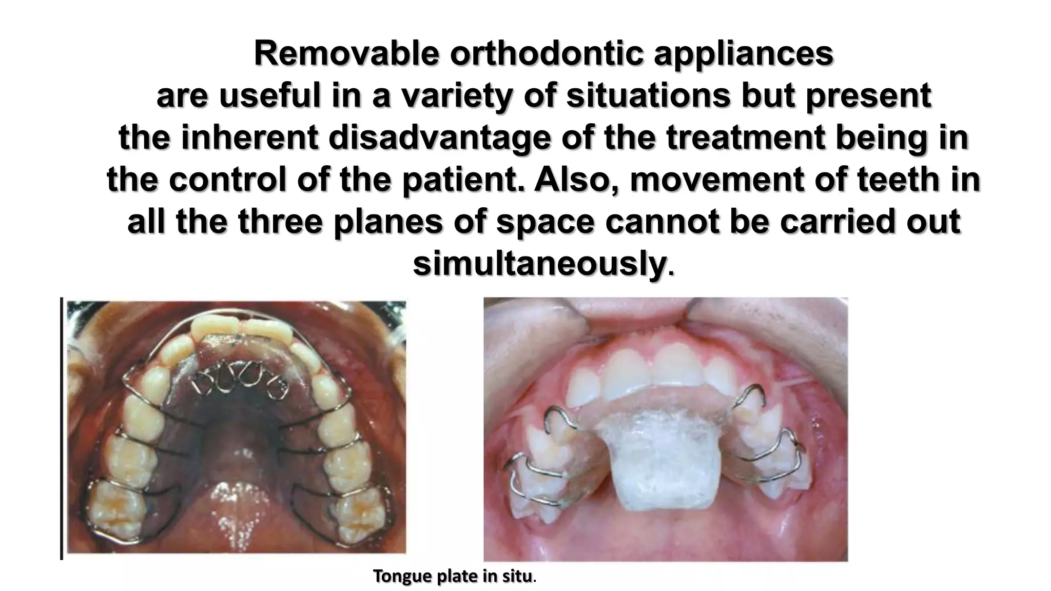 Removable orthodontic appliance | PPTX | Dental Health | Diseases and Conditions
