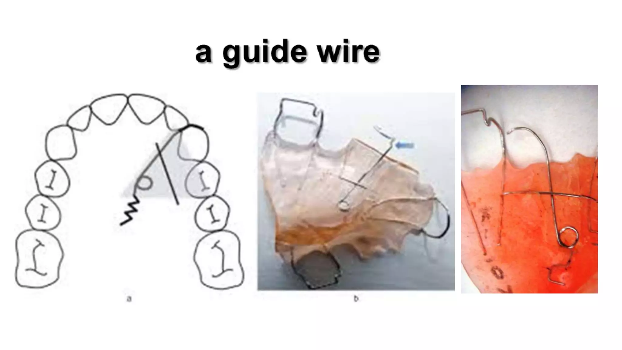 Removable orthodontic appliance | PPTX | Dental Health | Diseases and Conditions