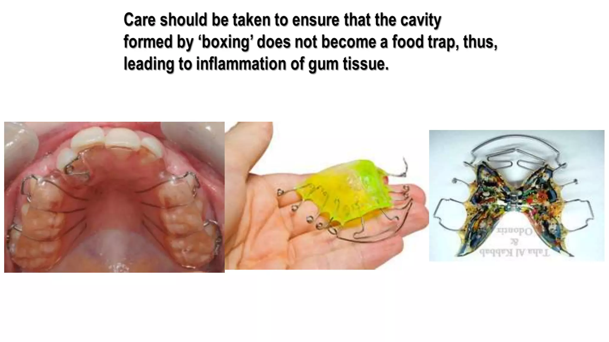 Removable orthodontic appliance | PPTX